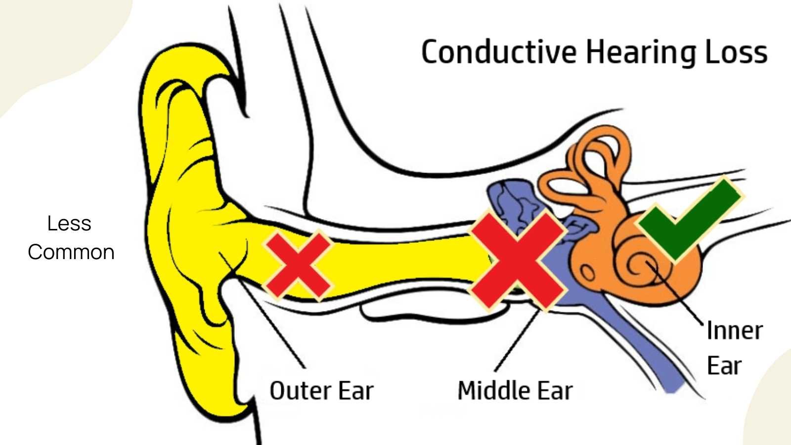 5 Most Common Types Of Hearing Problem - Margadarsi Foundation